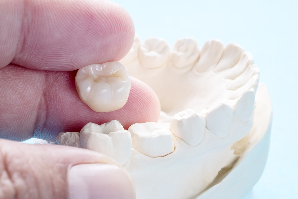 How Long Does it Take to Get a Dental Crown?